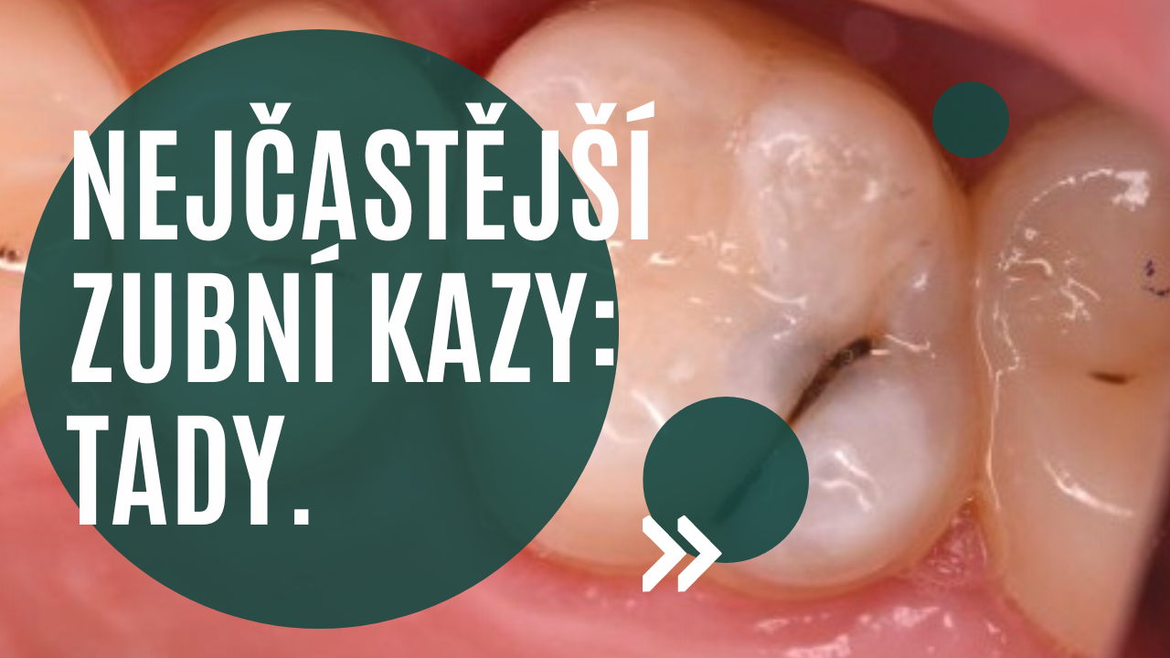 Kde naleznete nejčastější zubní kazy | Stream